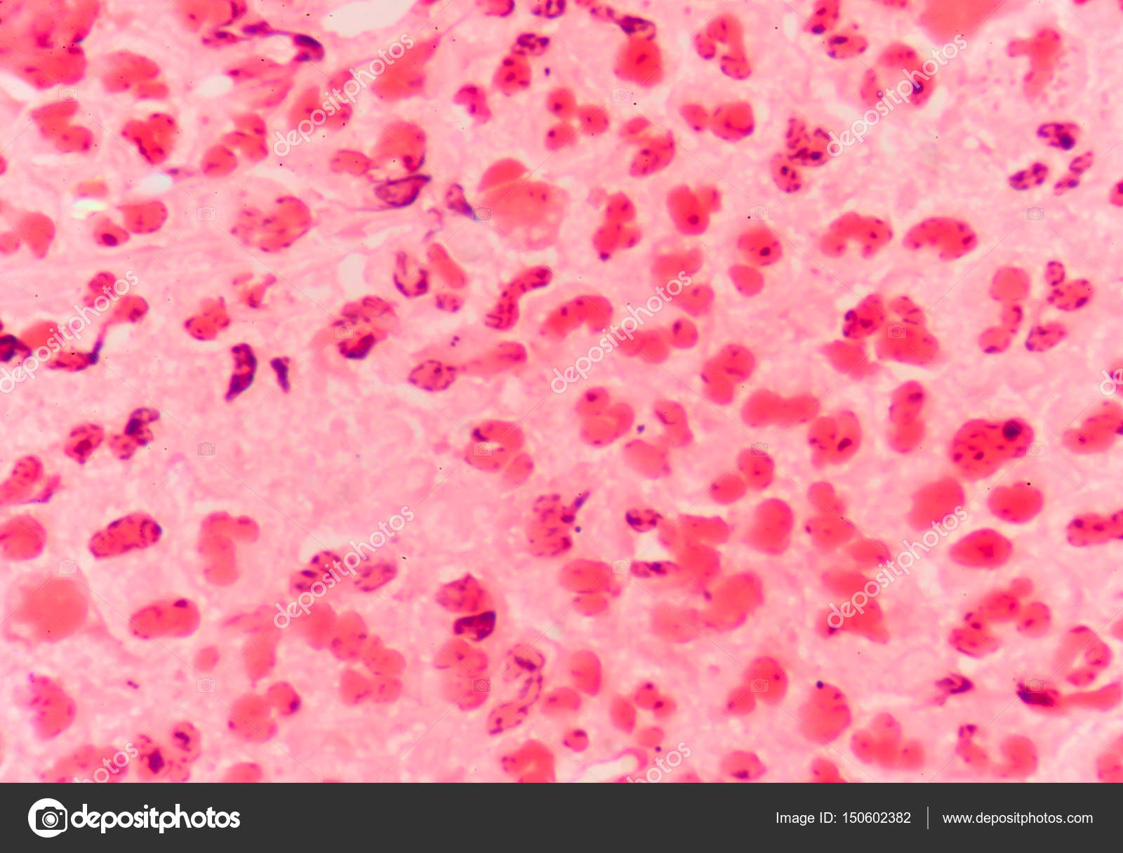 Gram Negative Diplococci In Sputum
