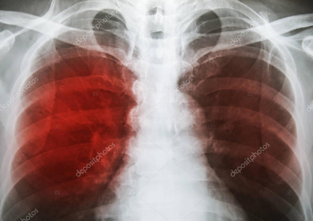 Tuberculosis pulmonar (TB): la radiografía de tórax muestra infiltrado ...