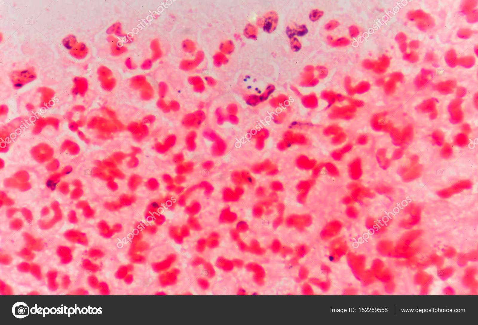 Moderate red white blood cells with gram negative diplococci. Stock ...