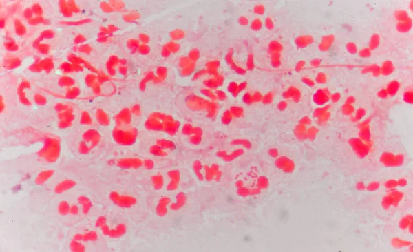 Moderate red white blood cells with gram negative diplococci. — Stock ...