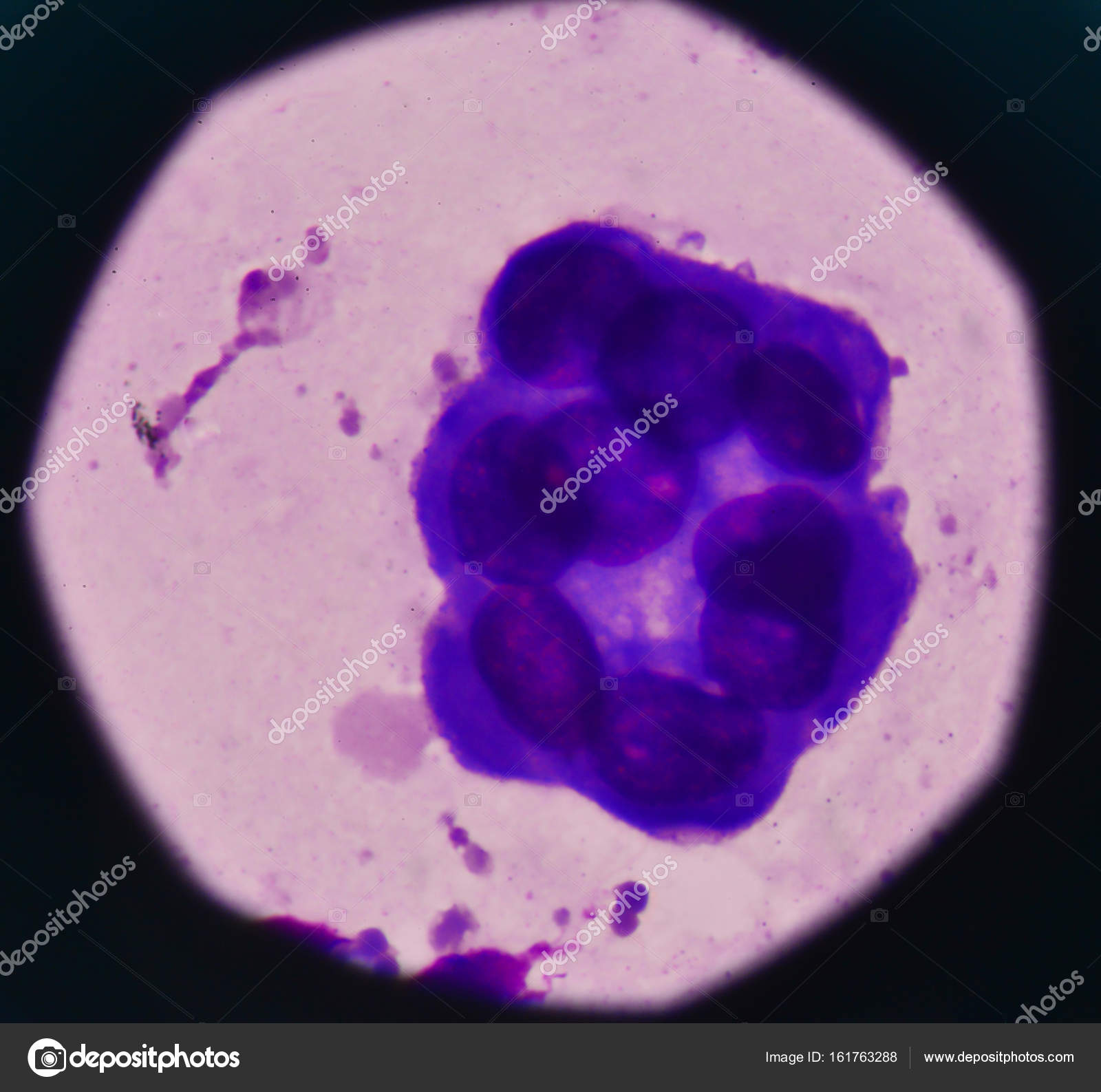Células malignas anormales espécimen líquido pleural . — Foto de stock ...