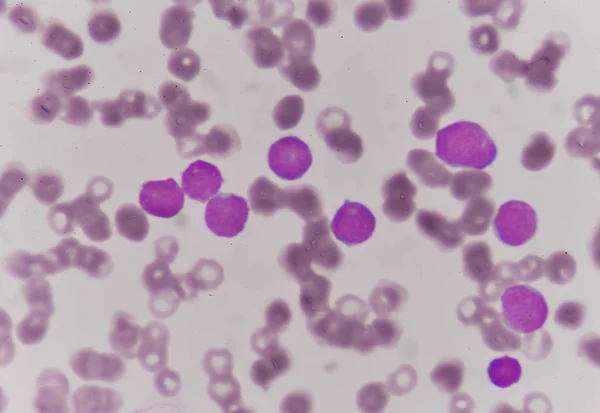 Blast cells in Leukemia Stock Photo by ©toeytoey 164030380