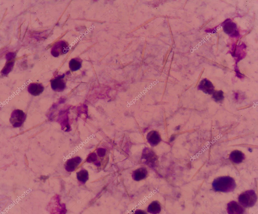 White blood cells with Uric acid crystal needle shape — Stock Photo ...