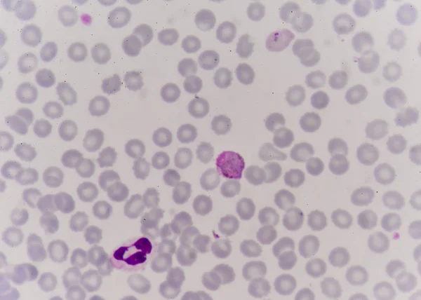 Lymphocytes atypiques Stock Photos, Royalty Free Lymphocytes atypiques ...