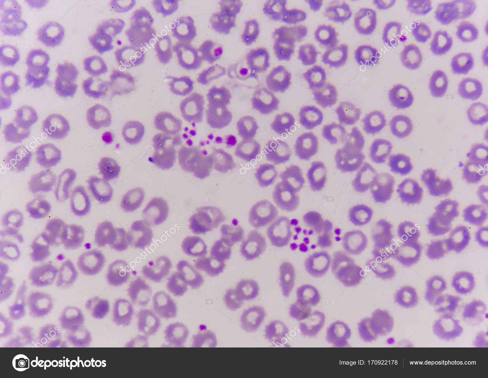 Platelet clumping as a possible cause of low platelet count in p Stock ...