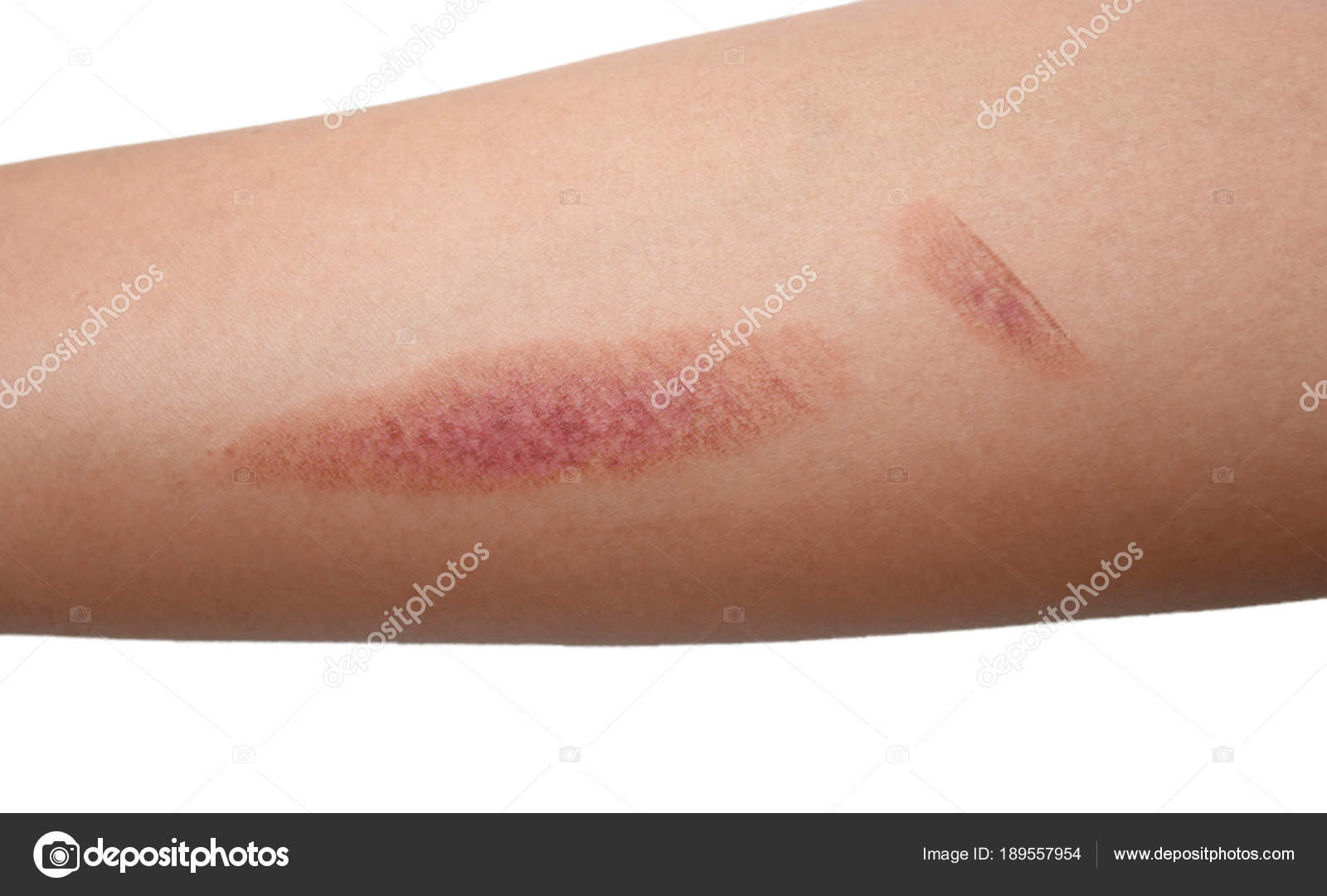 Burn wound on skin. Stock Photo by ©toeytoey 189557954