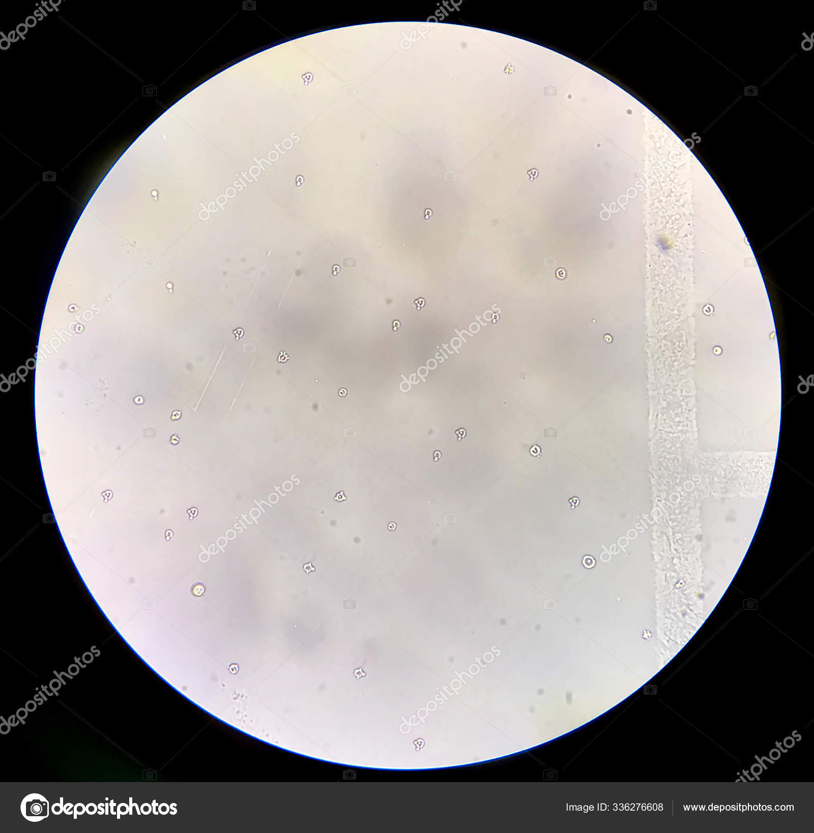 Dysmorphic red blood cells in urine sediment. — Stock Photo © toeytoey ...