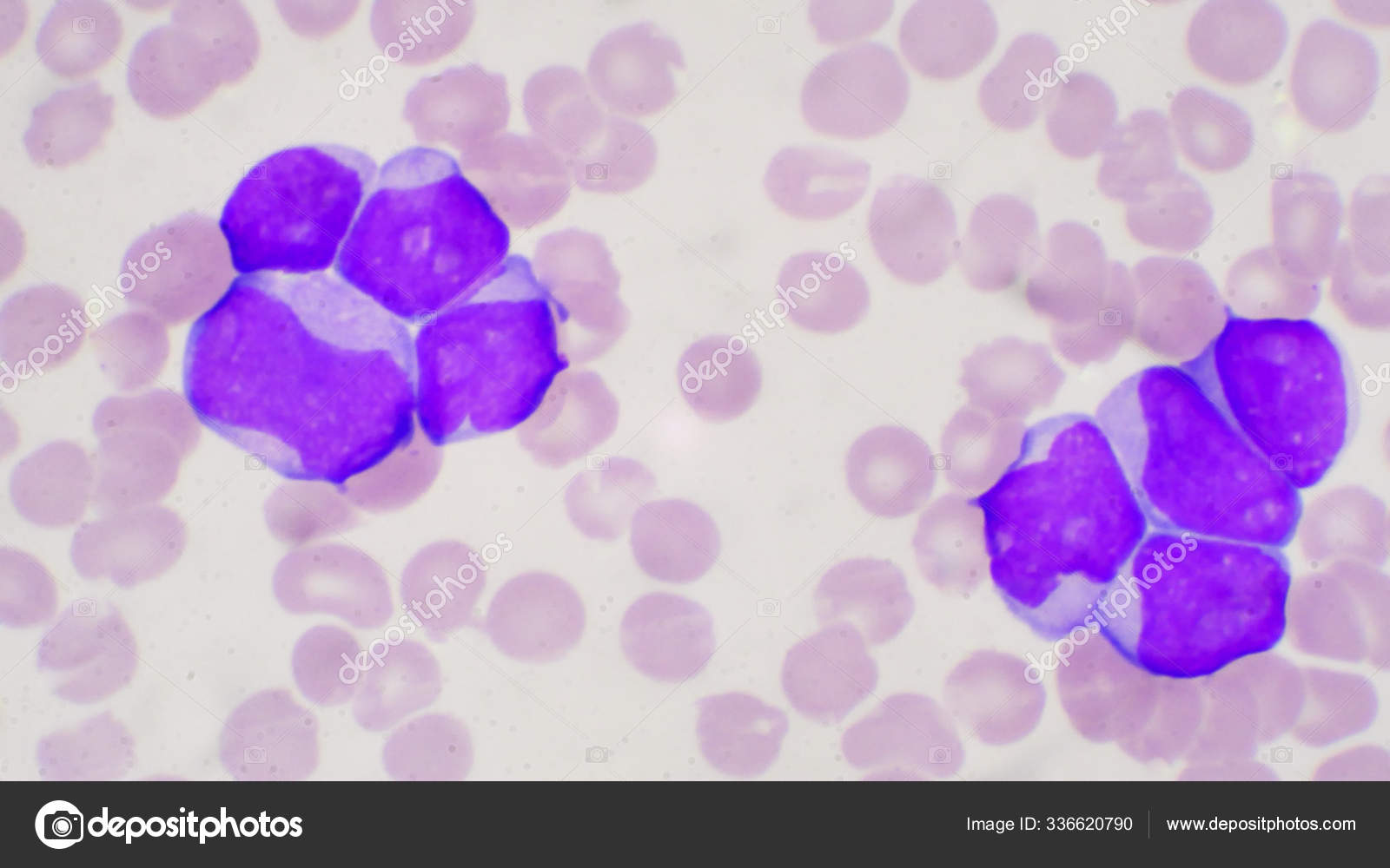 Blast cell in leukemia pateins in blood smear. Stock Illustration by ©toeytoey #336620790