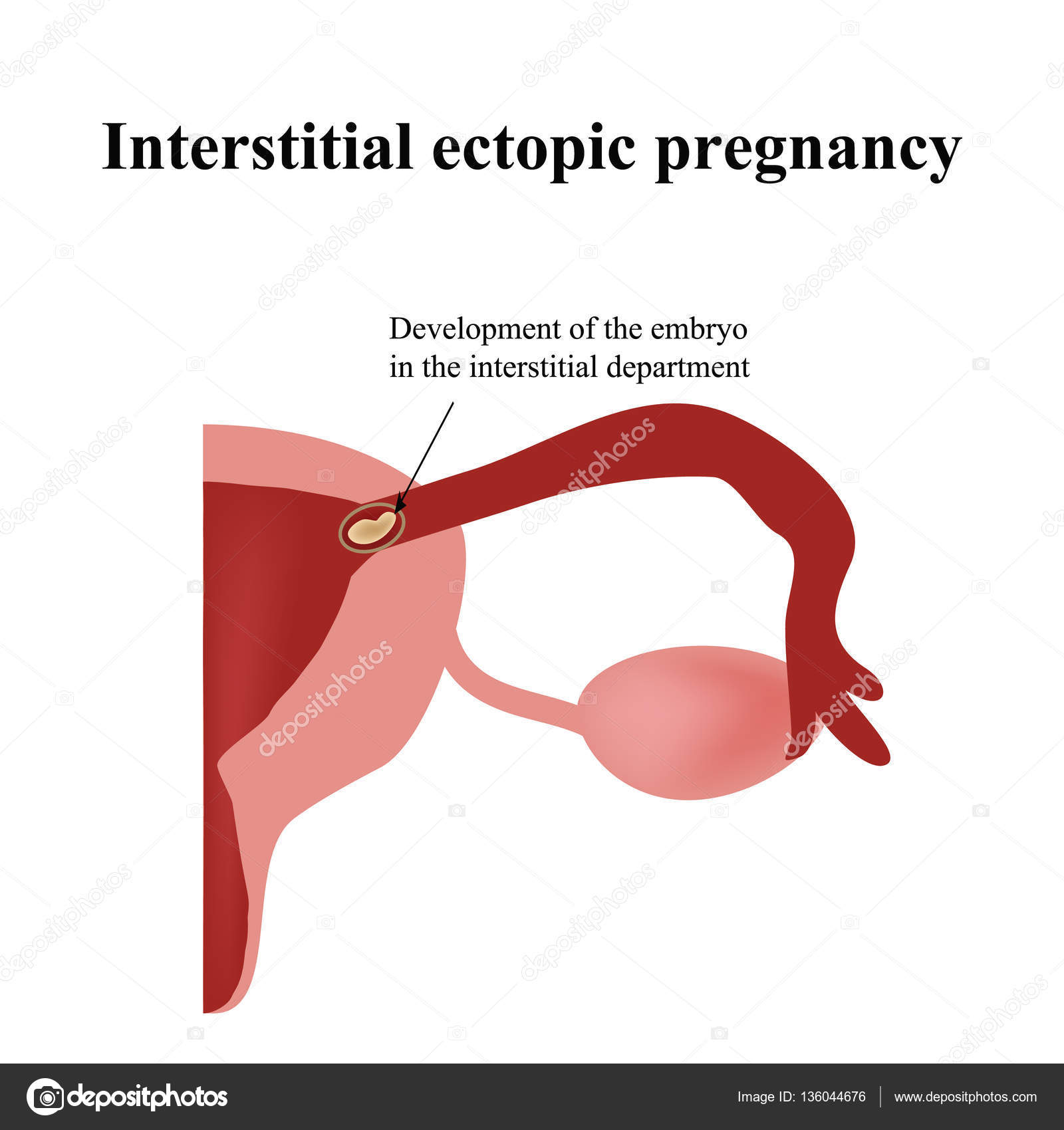 Development of the embryo in the interstitial department. Ectopic ...