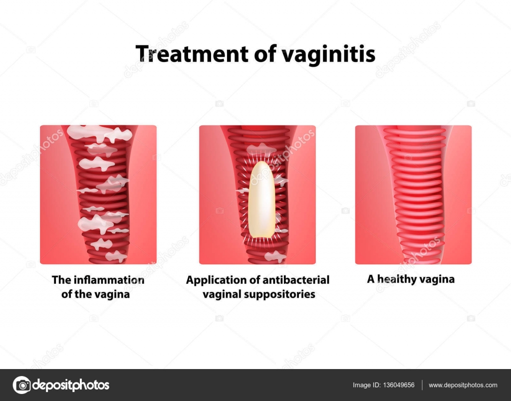 Treatment of vaginitis suppositories. inflammation the vagina ...