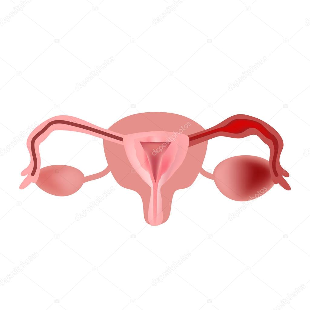 Salpingitis. Inflamaci n de la trompa de Falopio. Oforitis. el ovario ...