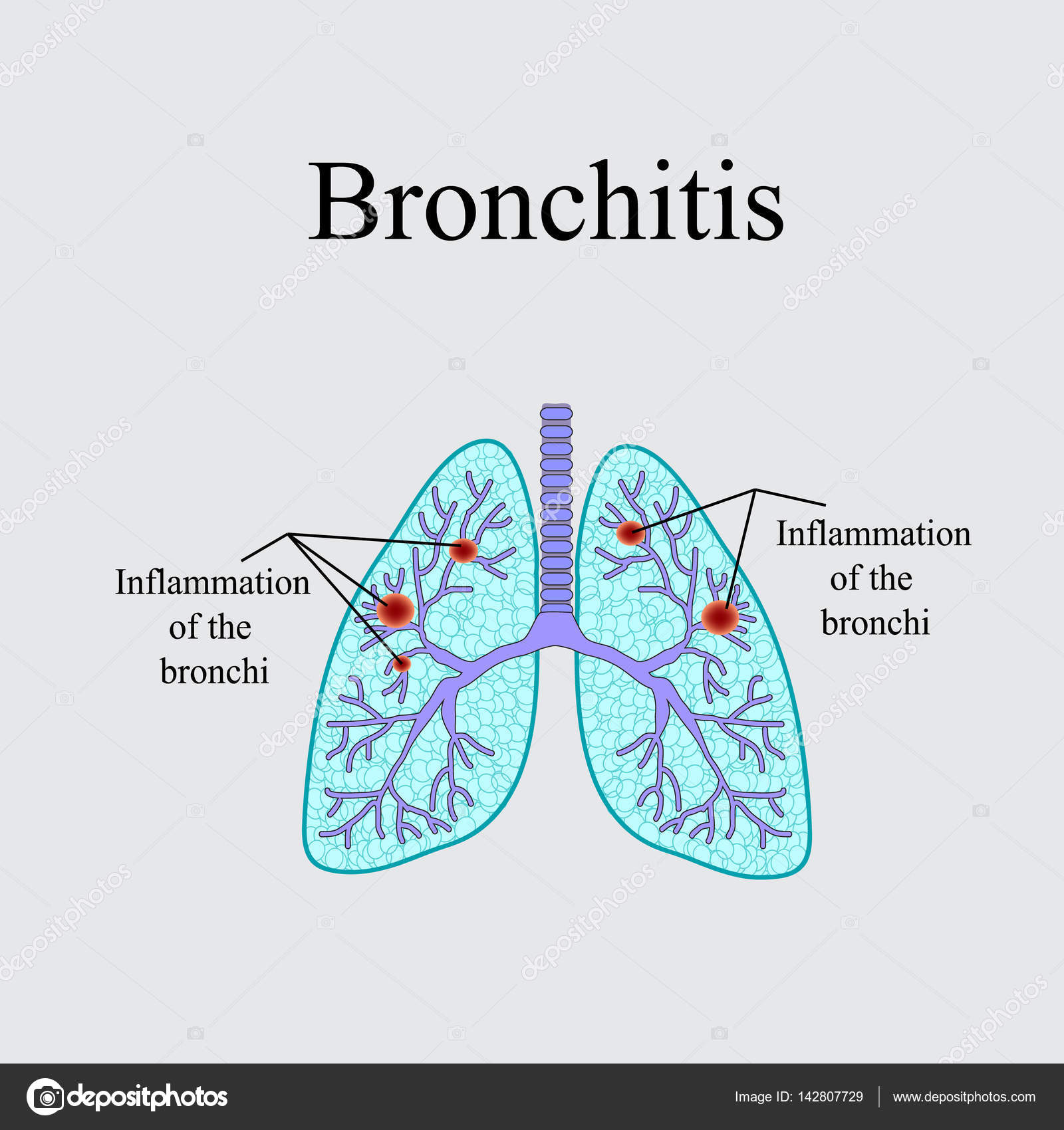 Bronchitis. Struktur anatomi paru-paru manusia. Ilustrasi vektor pada ...
