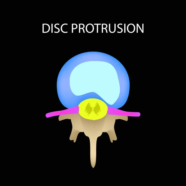 Protrusion Stock Vectors, Royalty Free Protrusion Illustrations ...