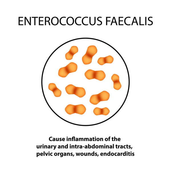 Enterococcus faecalis. Flora patógena. La bacteria causa enfermedades ...