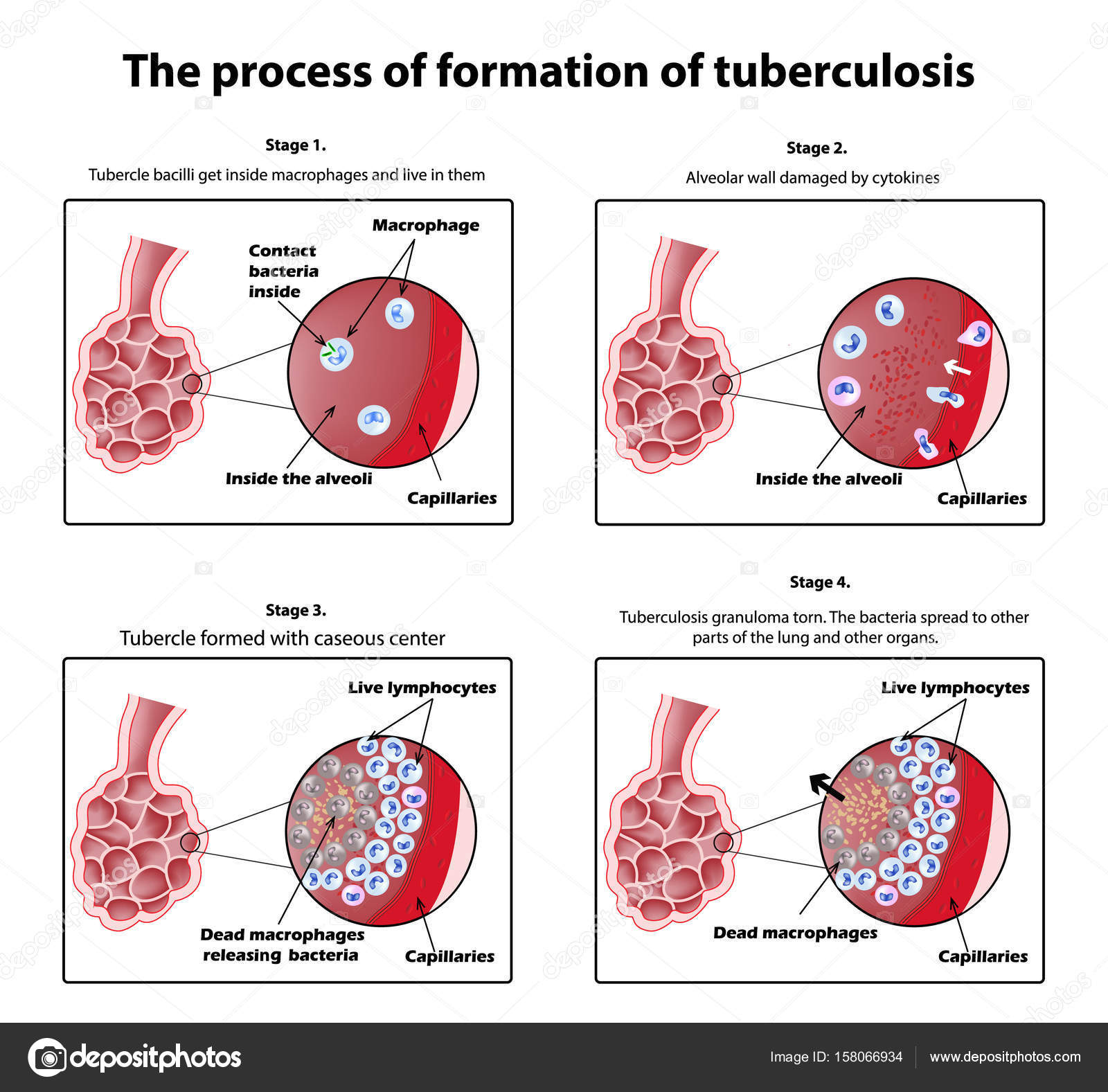 The process of tuberculosis formation. Infographics. Vector ...