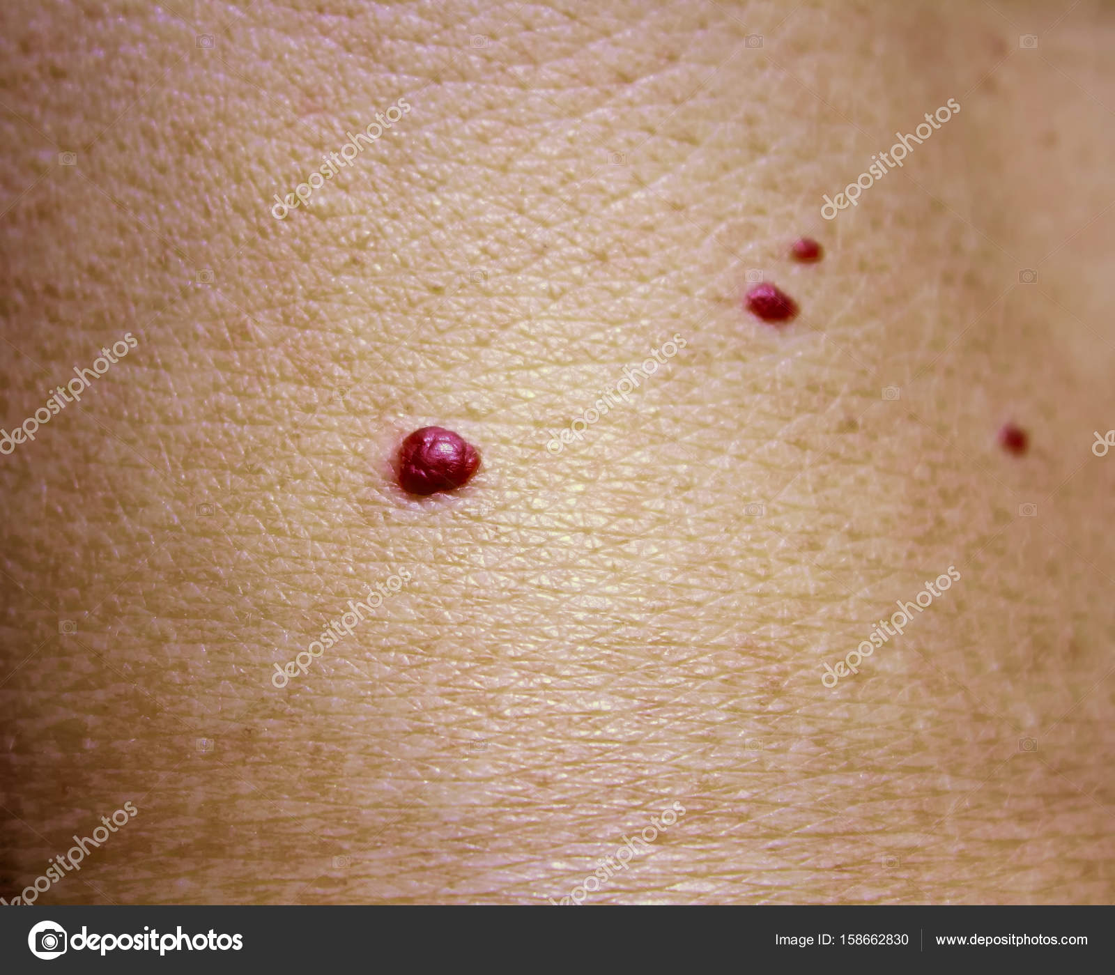 Angioma. Marca de nacimiento roja en la superficie de la piel ...