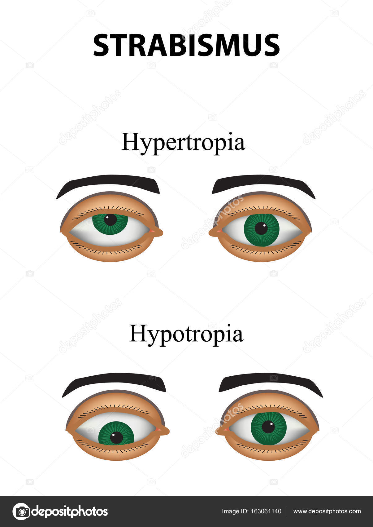Strabismus. Hypertropia. Hypotropia. Infographics. Vector illustration ...