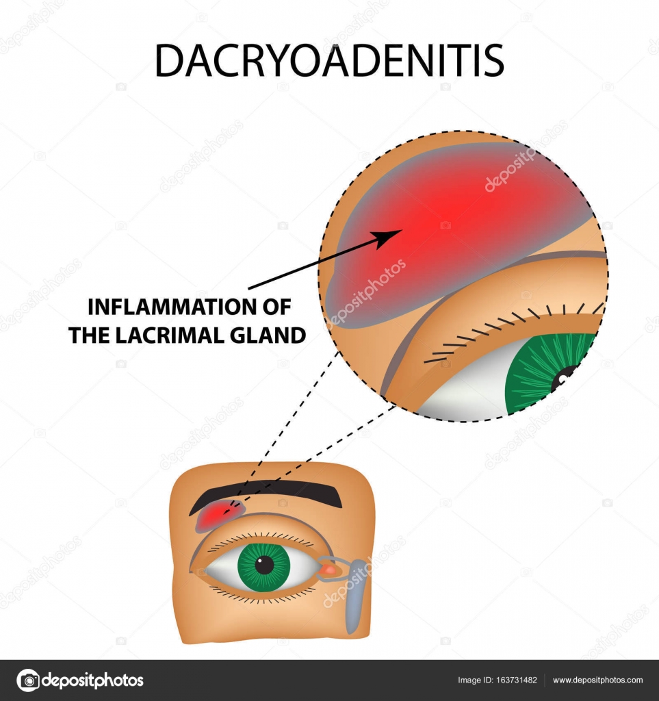 Dacrioadenitis. Inflamación de la glándula lagrimal. La estructura del ...
