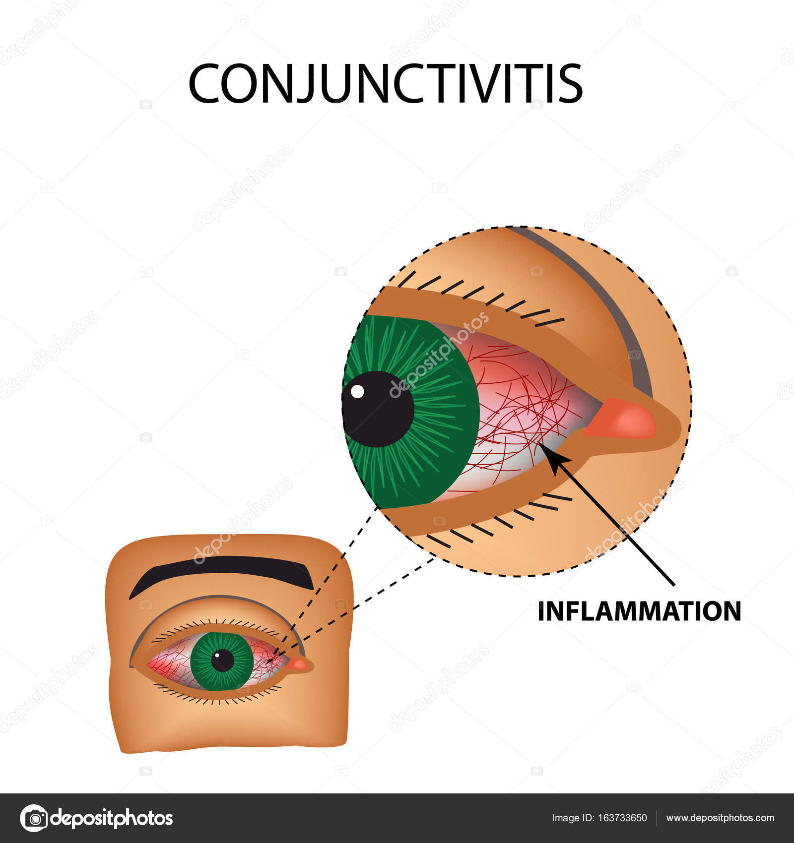 Conjunctivitis. Redness and inflammation of the eye. Vessels in the eye ...