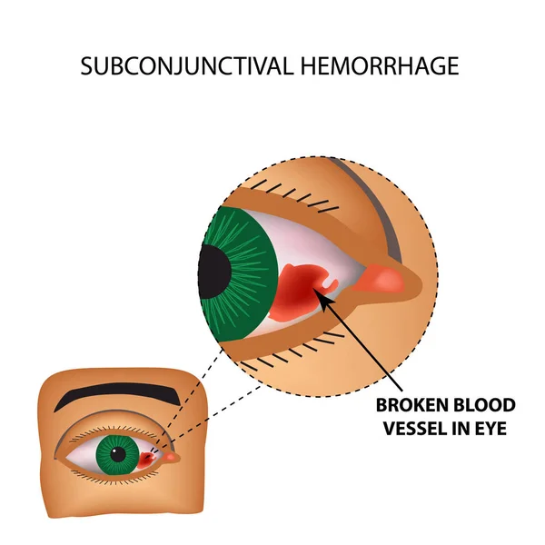 Hemorragia ocular imágenes de stock de arte vectorial | Depositphotos
