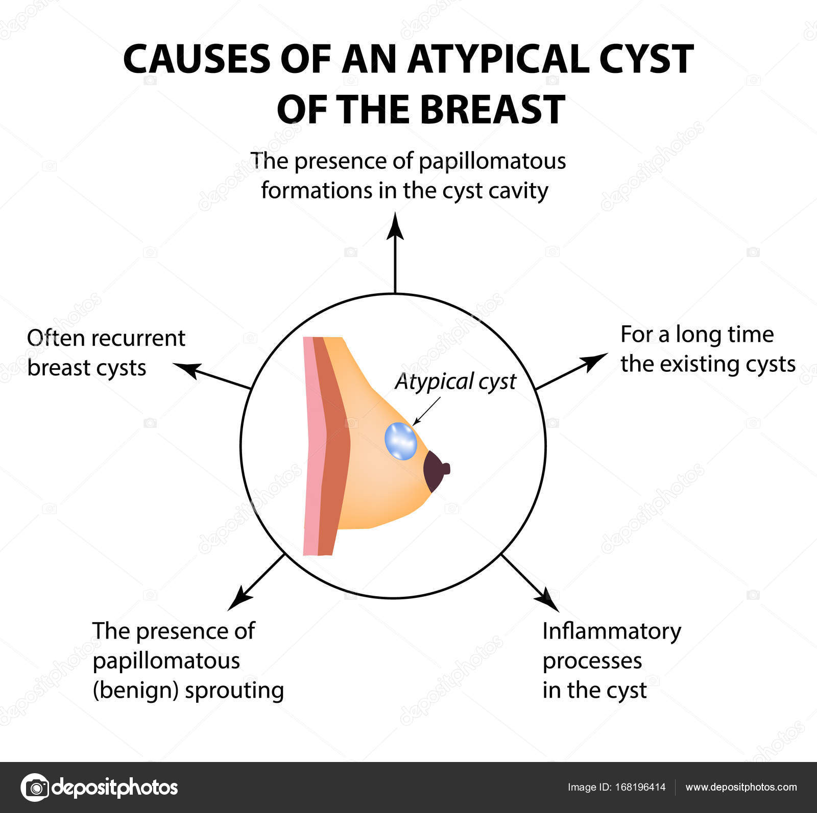What Are The Signs And Symptoms Of Breast Cyst at Zane Finlayson blog
