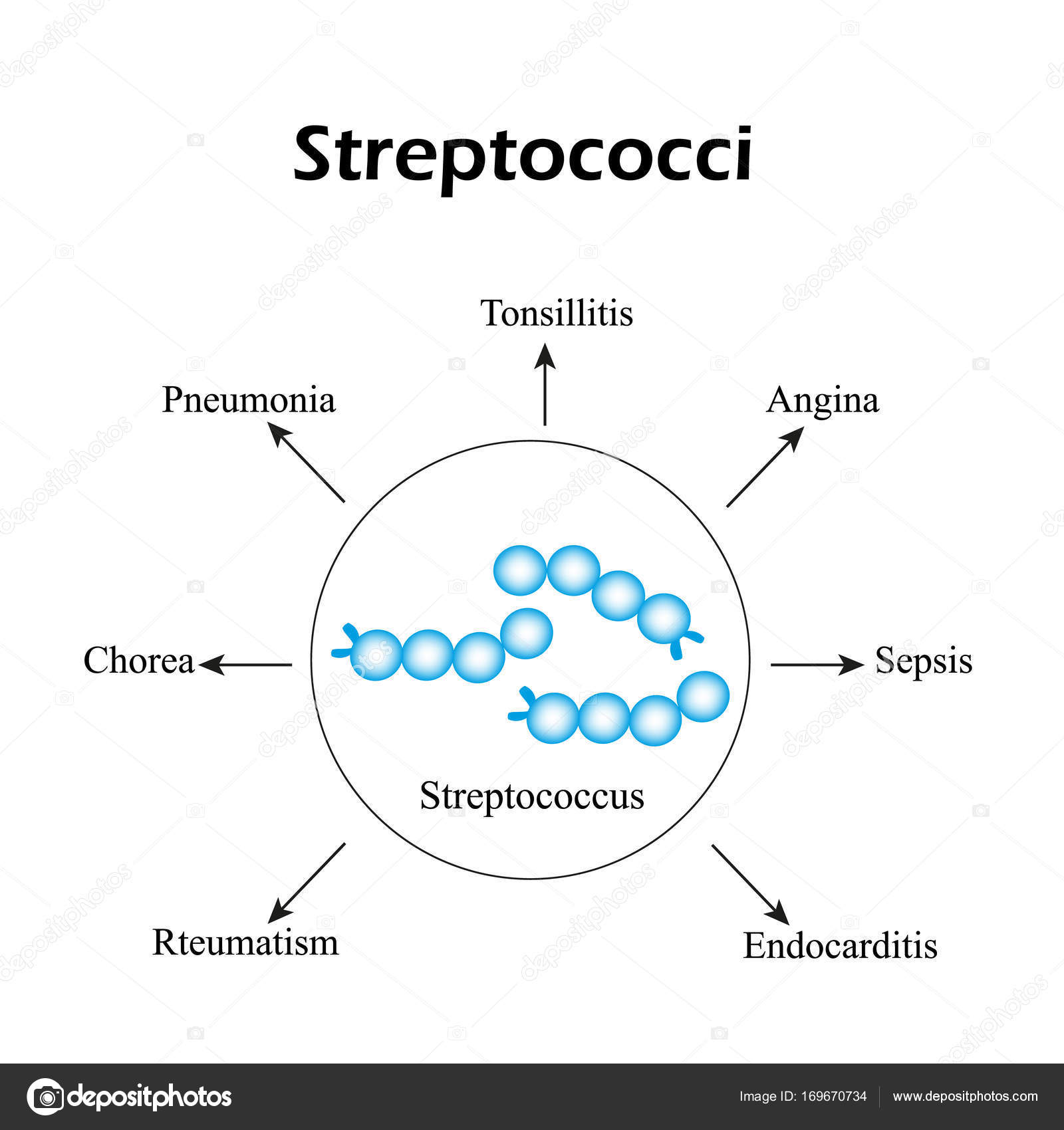 Estreptococos. Enfermedades estreptocócicas. Infografías. Ilustración ...