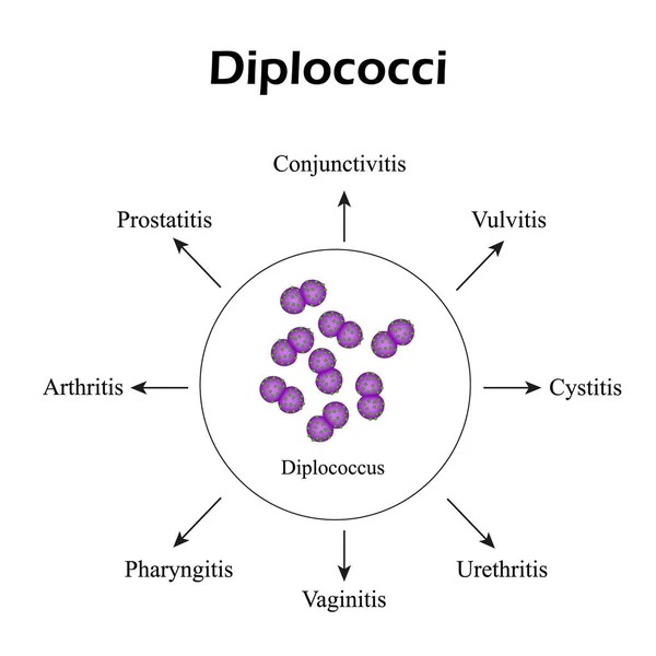 Diplococos. La enfermedad es causada por diplococos. Infografías ...