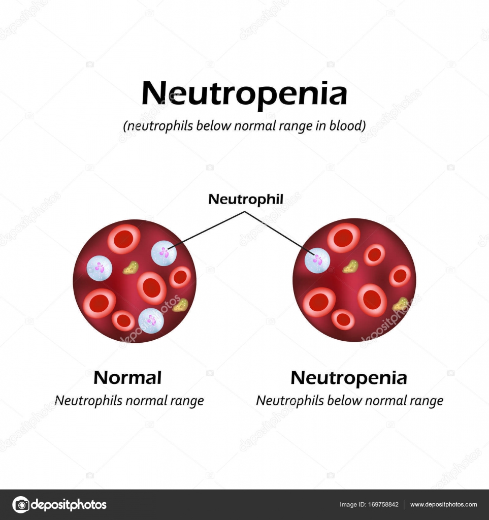 Neutrófilos abaixo do intervalo normal no sangue. Neutropenia ...