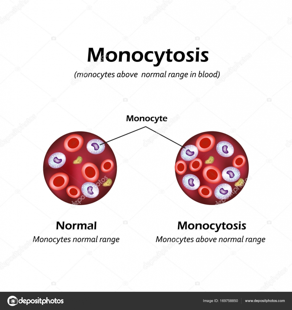 Monocytes above the normal range in the blood. Monocytosis. Vector ...