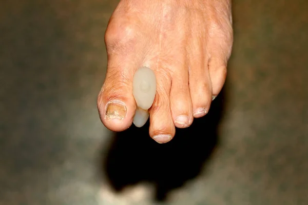 Interdigital pads. partitions. Foot. Corn on toes. Curvature of fingers ...