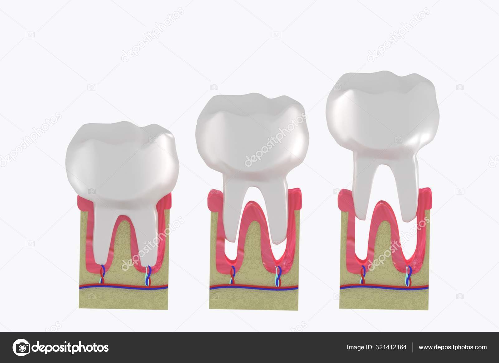 Molar extraction. Tooth loss Anatomical structure. 3d medical ...