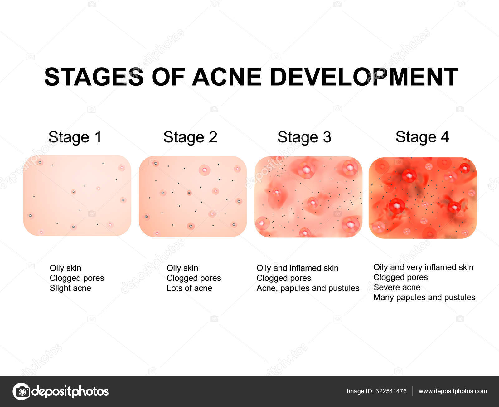 Etapas de desarrollo del acné. Piel inflamada con cicatrices, acné y ...