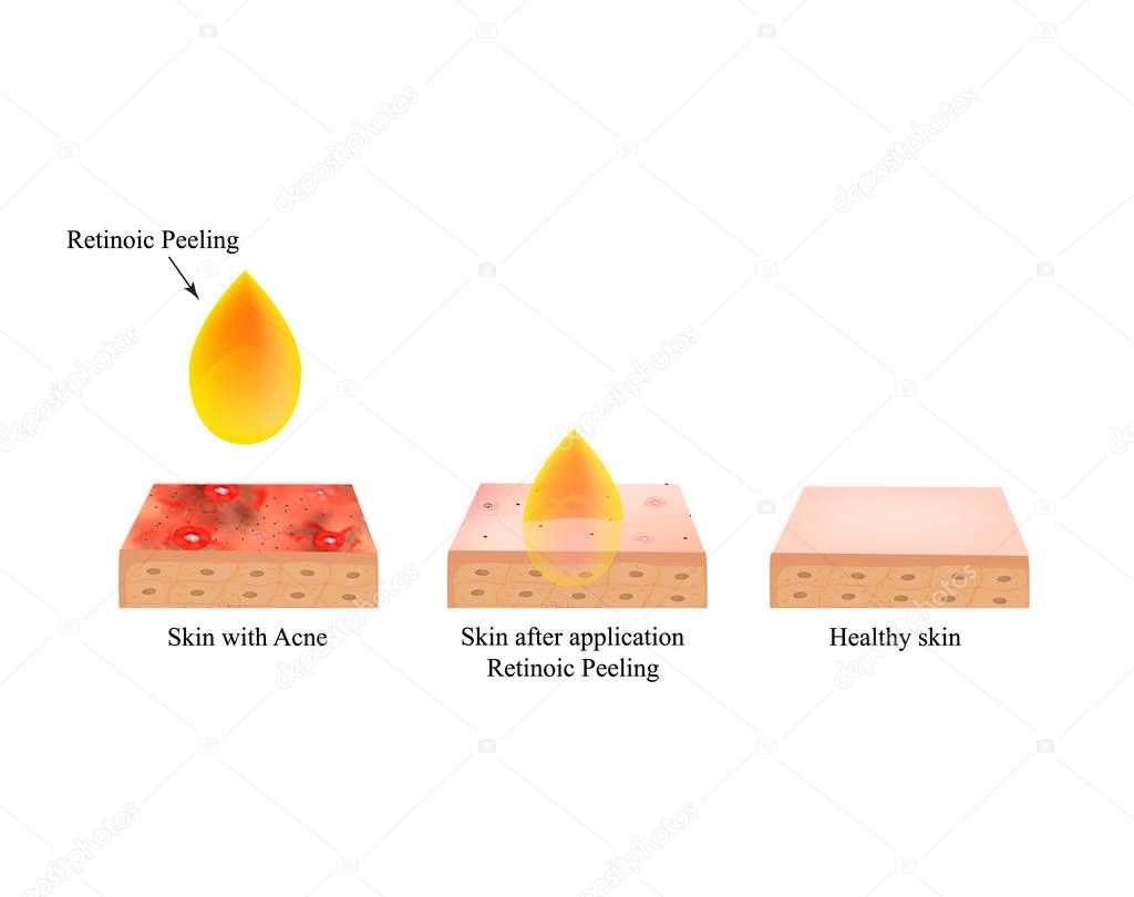 Peeling retinoico para el acné. Acné de piel inflamada. Acné purulento ...