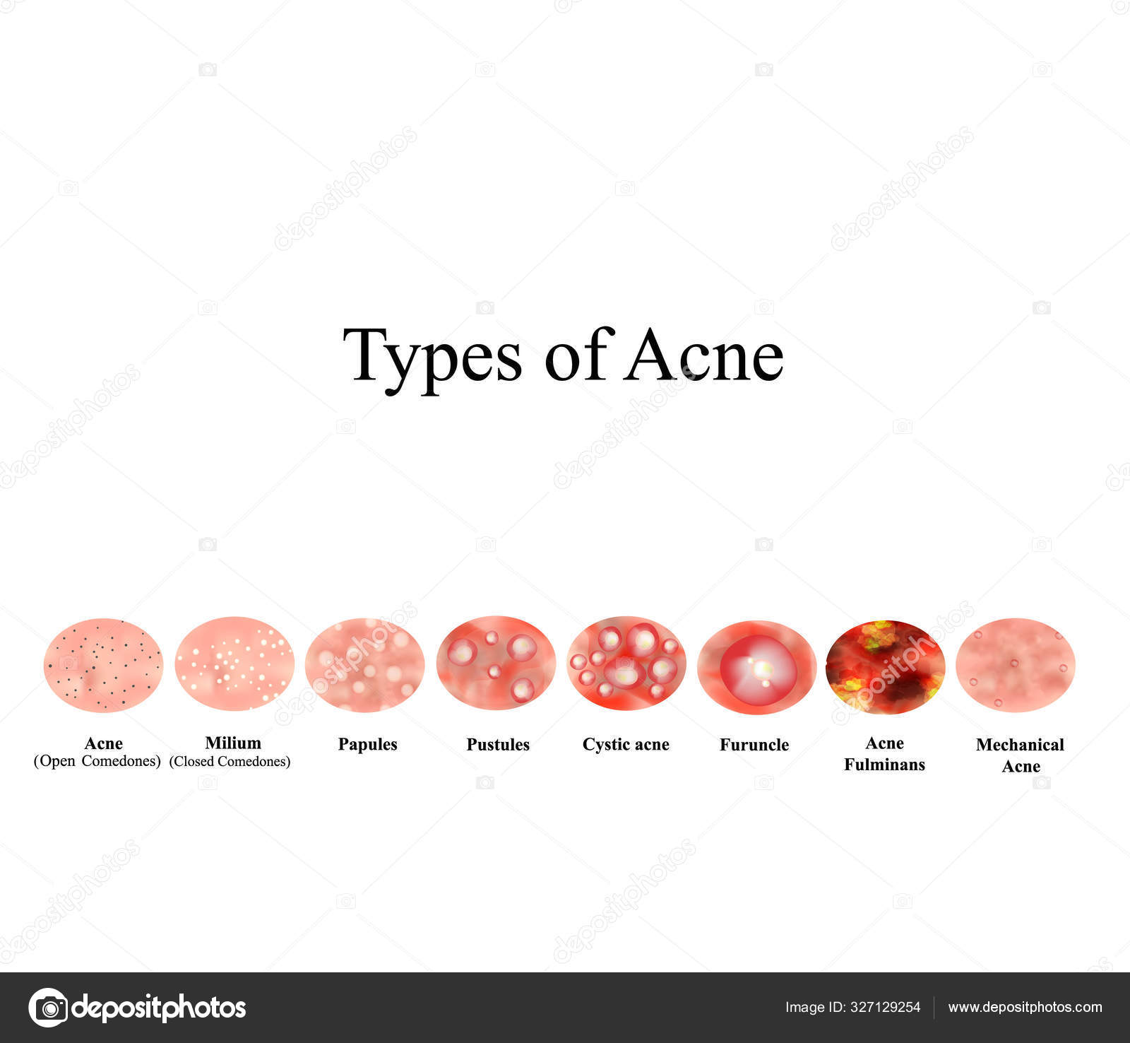 Acne Pustules