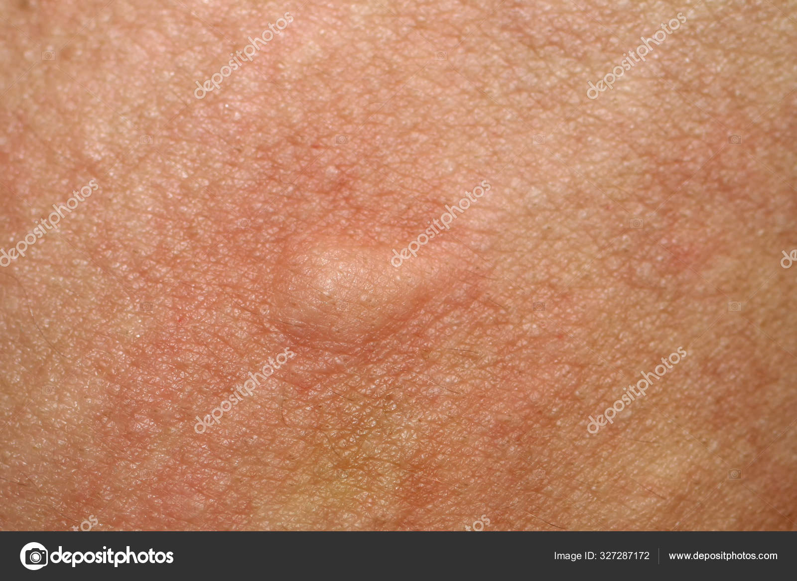 A bite on the skin. Tumor on the skin. Stock Photo by ©mikrostoker ...