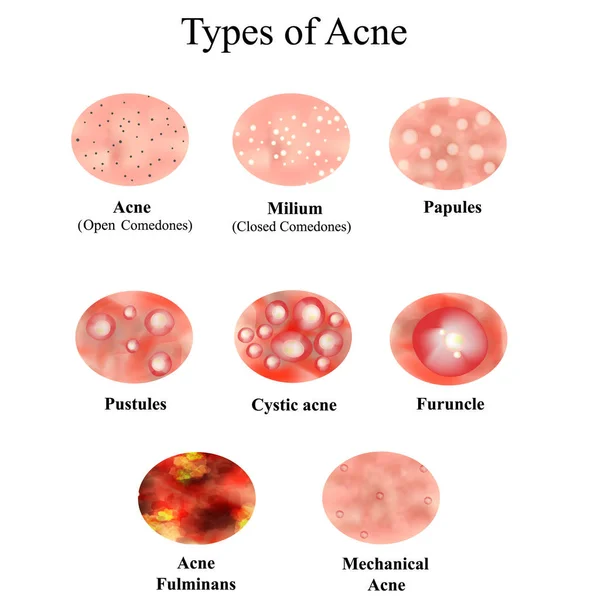 Acne skin Stock Vectors, Royalty Free Acne skin Illustrations ...