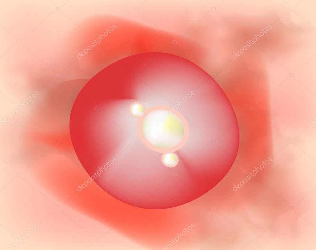 Pústulas en la piel. Acné quístico. Espinillas en el fondo de la piel ...