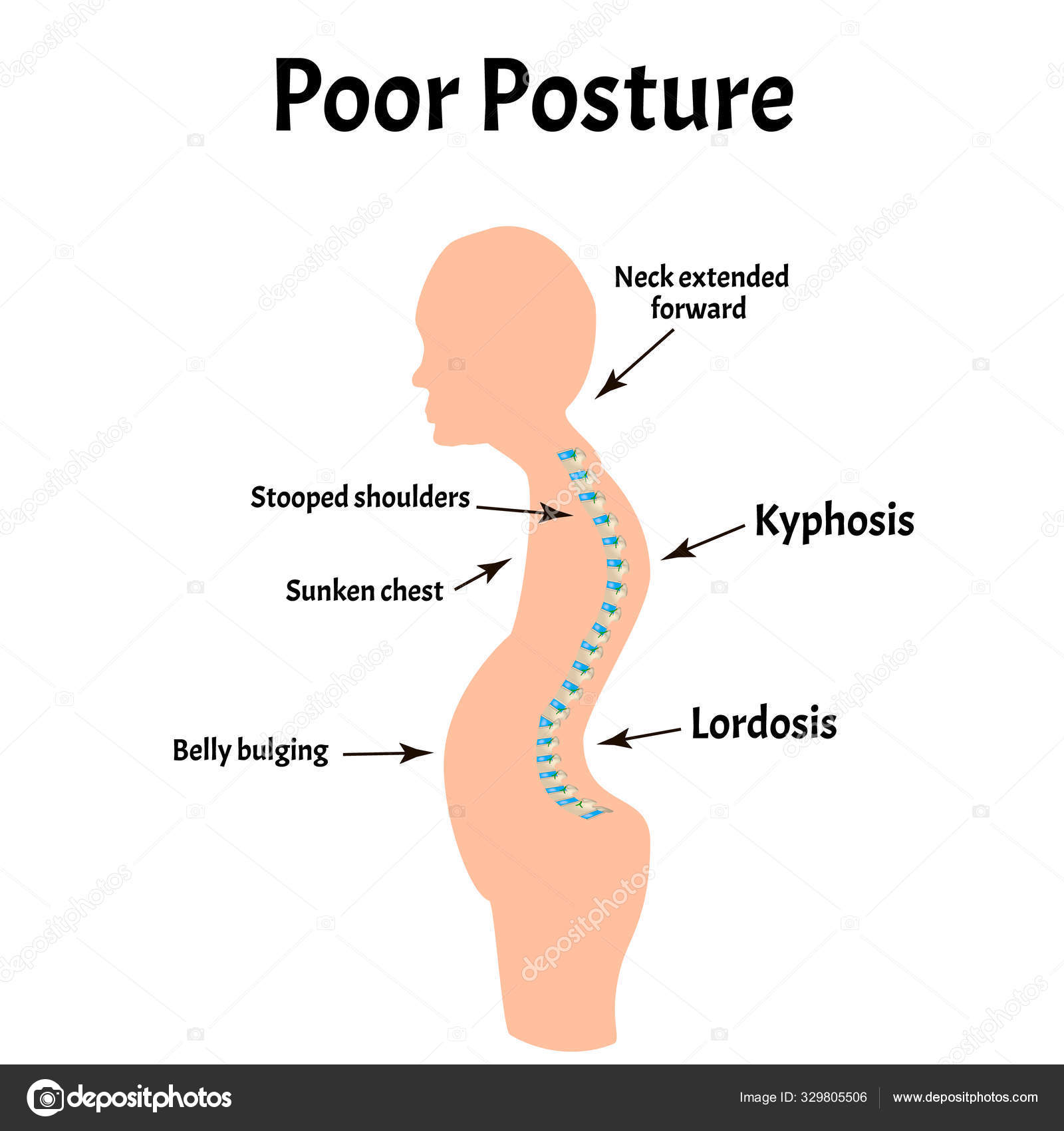 Kyphotic Posture