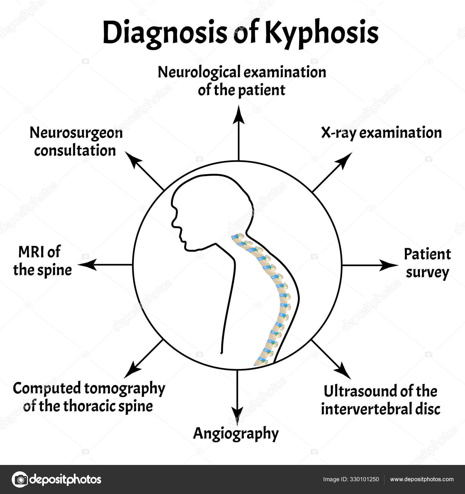 Diagnoosi kyfoosista. Selkäydin, kyfoosi, lordoosi, skolioosi ...