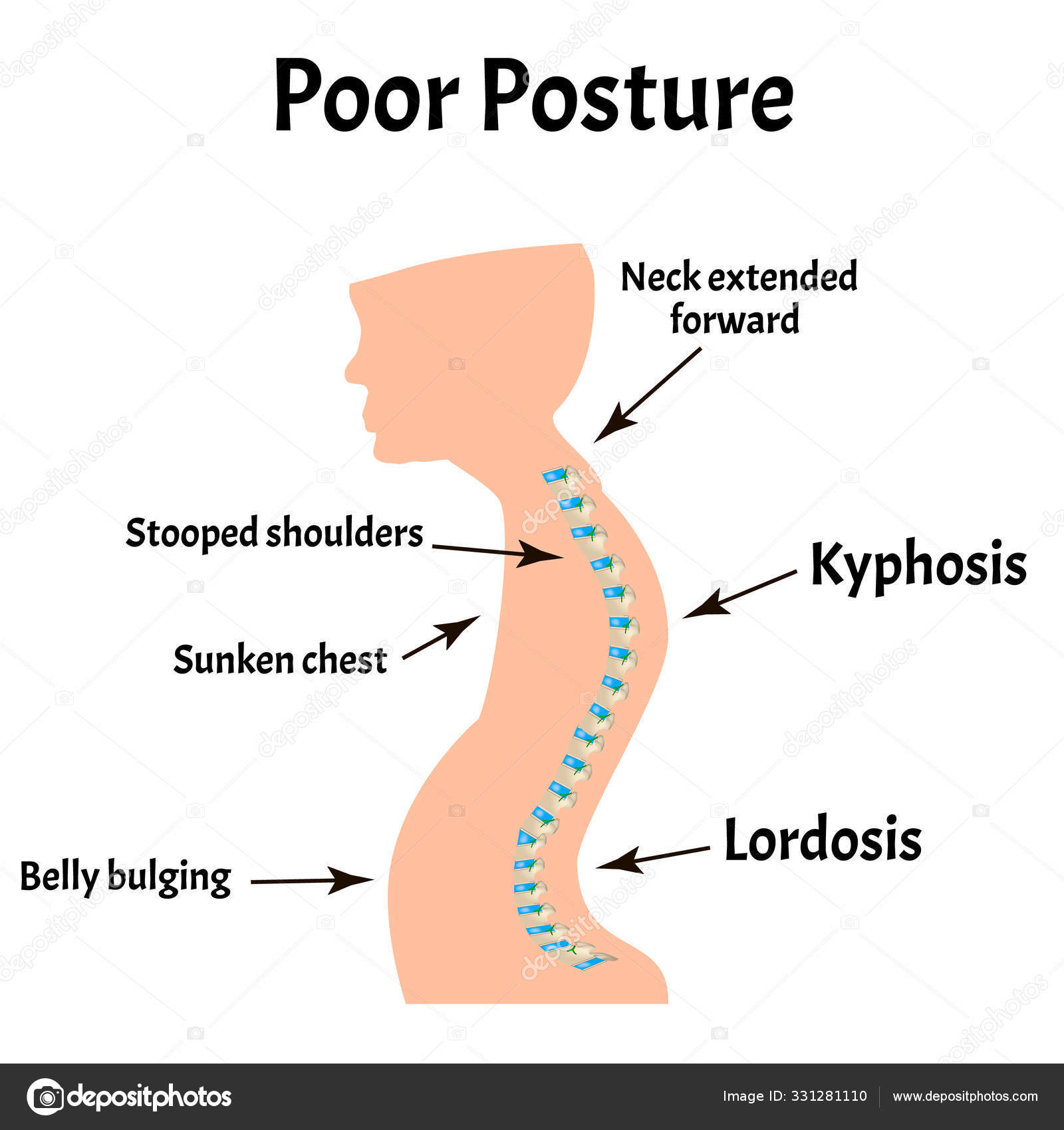 Improper posture symptoms. Text Neck Syndrome. Spinal curvature ...