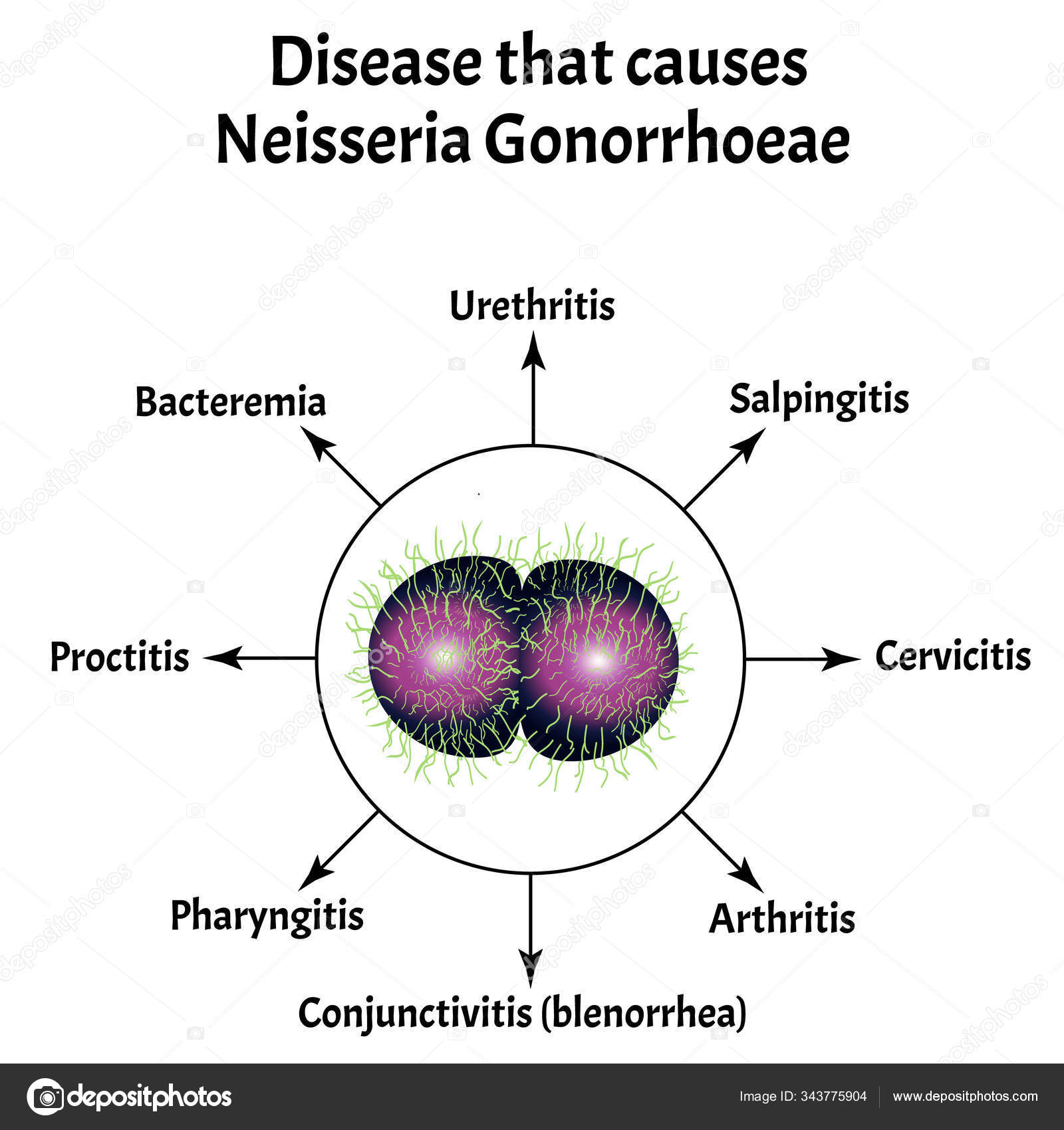 Gonorrhea Vector Illustration Labeled Std Disease