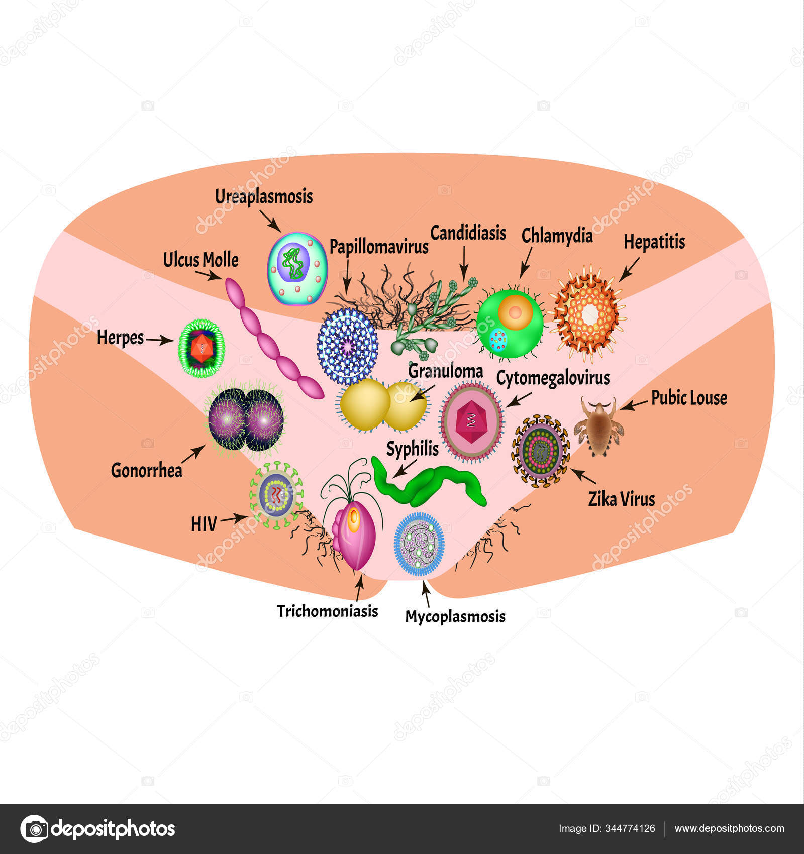 Maladies Sexuellement Transmissibles Grossesse, Infections
