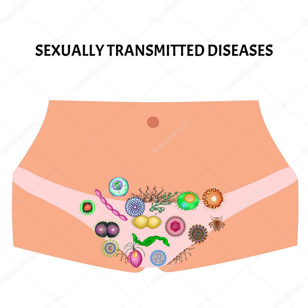 Infecciones virales y bacterianas. Enfermedades de transmisión sexual. Infografías. Ilustración ...