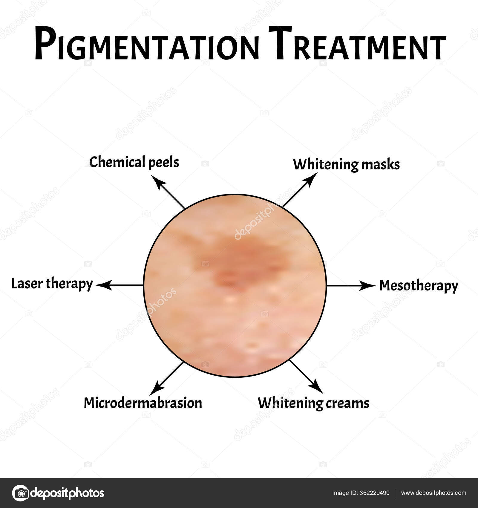 Skin Pigmentation Brown Patches