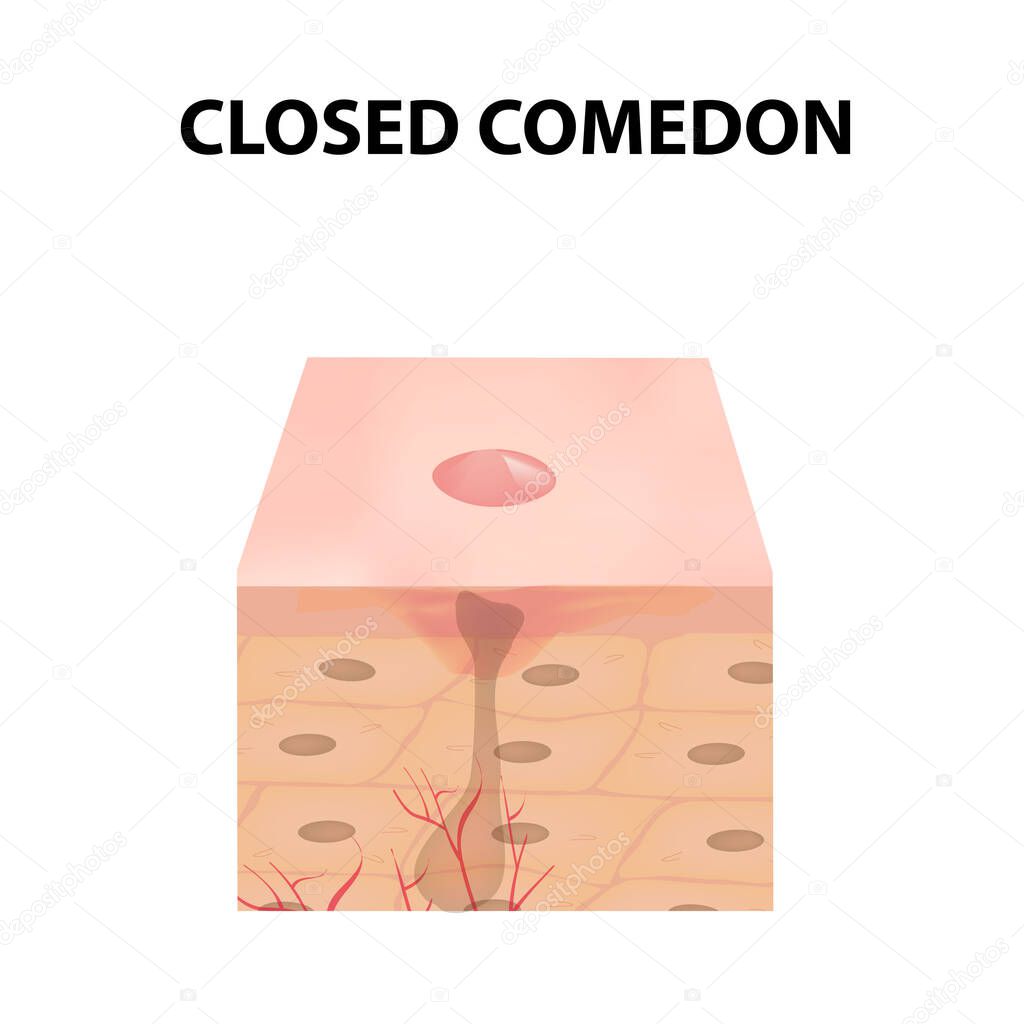 Comedones cerrados. Acné en la piel. Enfermedades dermatológicas y ...