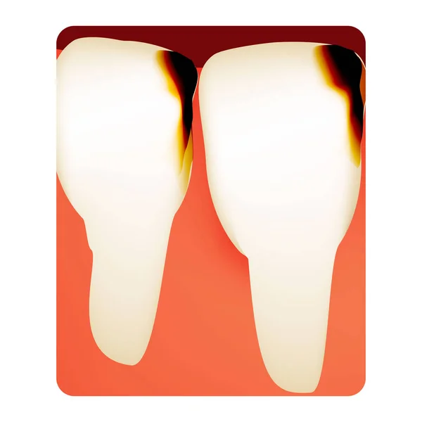 Types Of Dental Caries Infographics Vector Illustration On Isolated Background Stock Vector