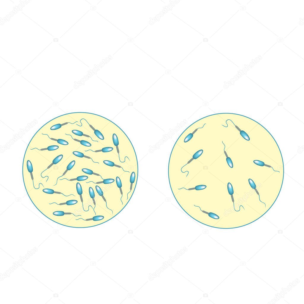Bajo Recuento De Espermatozoides En Líquido Seminal Baja Abundancia De