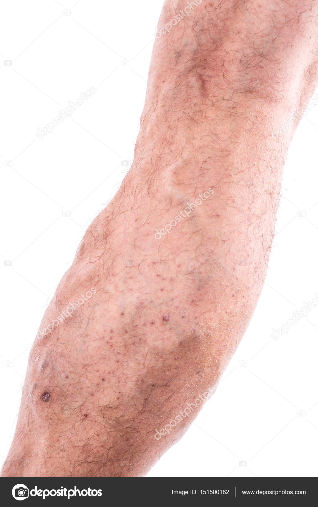Human leg with blocked veins — Stock Photo © fotoevent.stock #151500182
