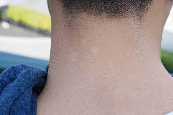 Pimples on neck Stock Photos, Royalty Free Pimples on neck Images ...