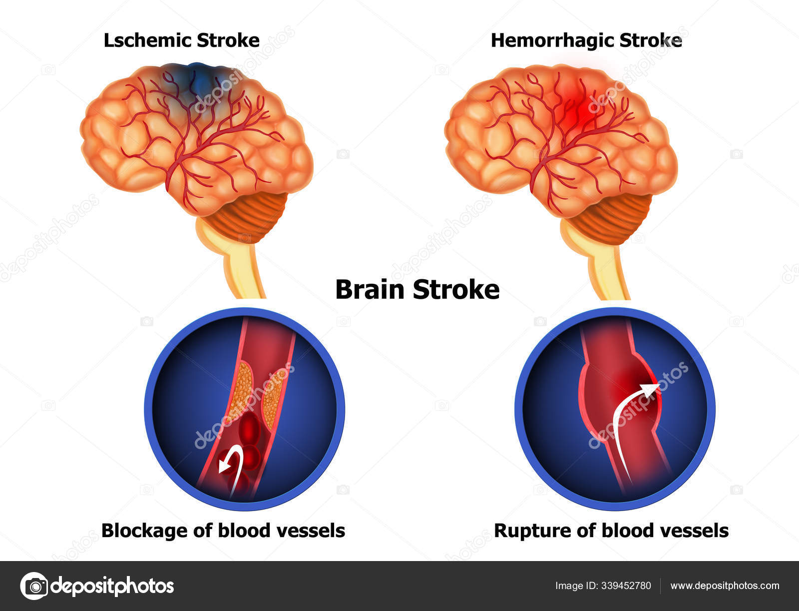 Ilustración Del Ataque Cerebral Humano — Foto de stock #339452780 ...
